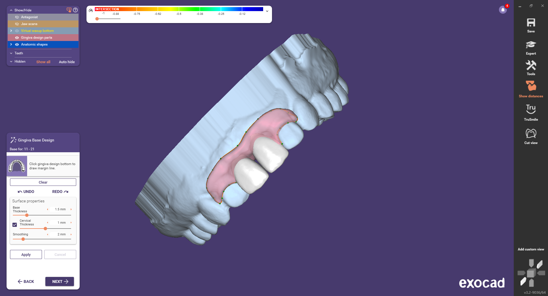 Workflow Guide: 3D Printing Flexible Dentures with HeyGears UltraCraft ...