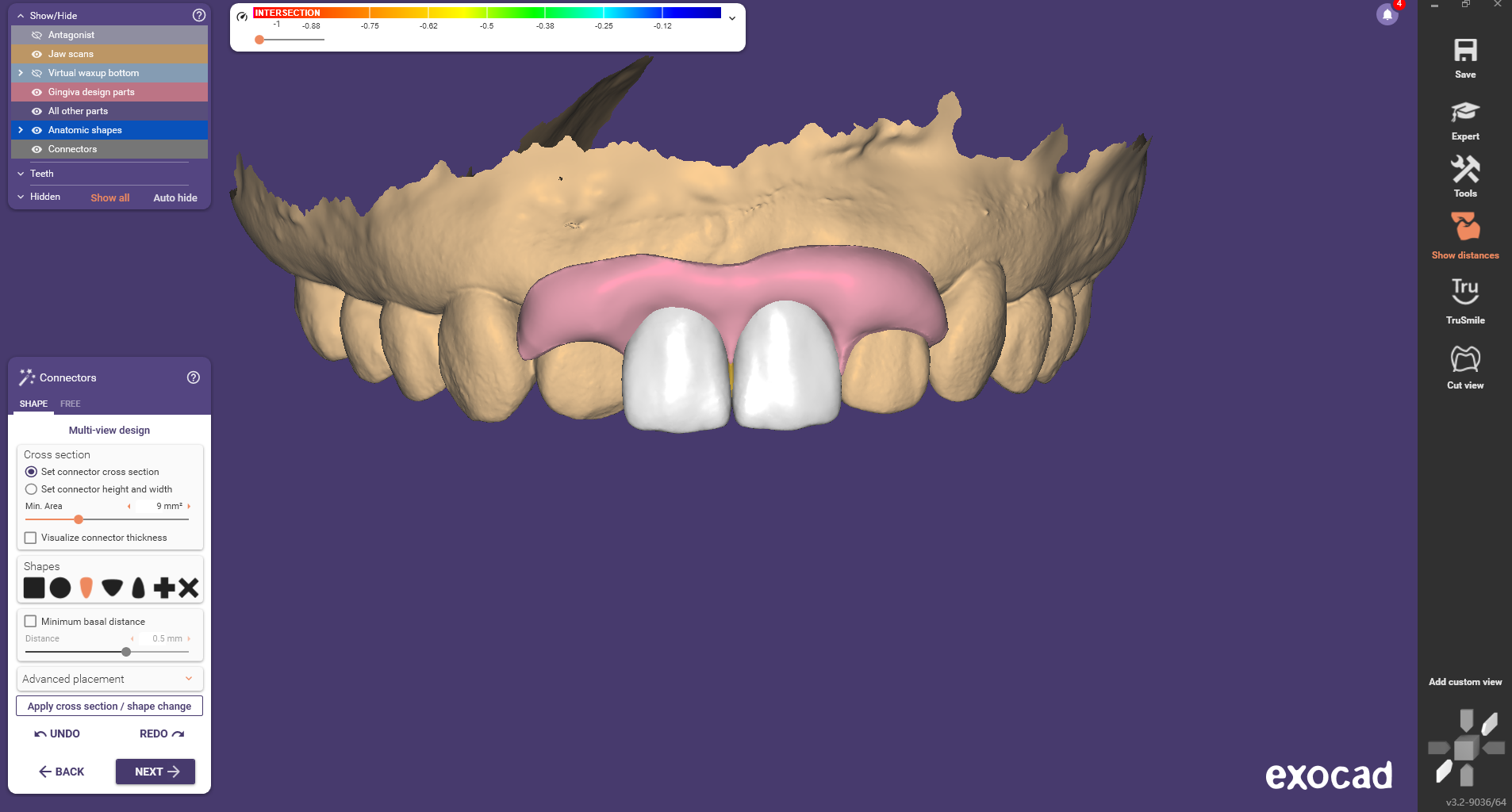 Workflow Guide: 3D Printing Flexible Dentures with HeyGears UltraCraft ...