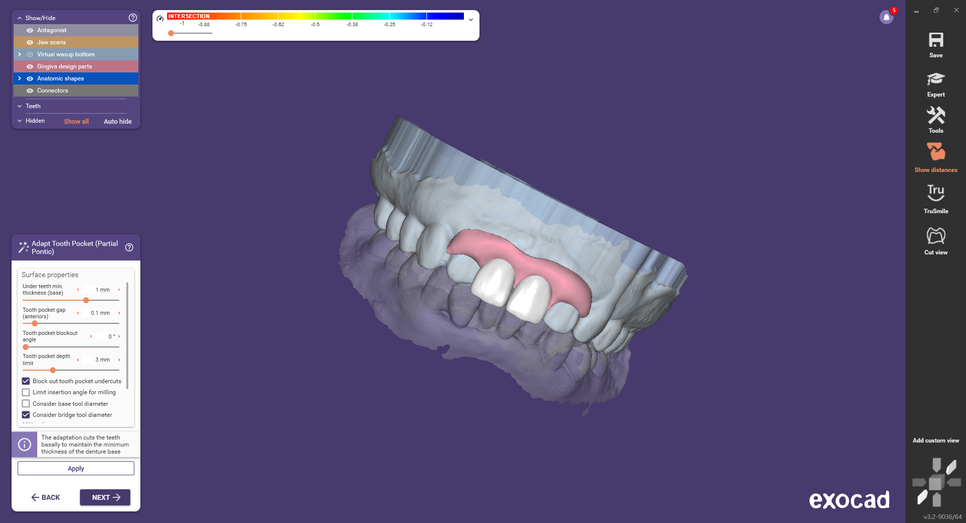 Workflow Guide: 3D Printing Flexible Dentures with HeyGears UltraCraft ...