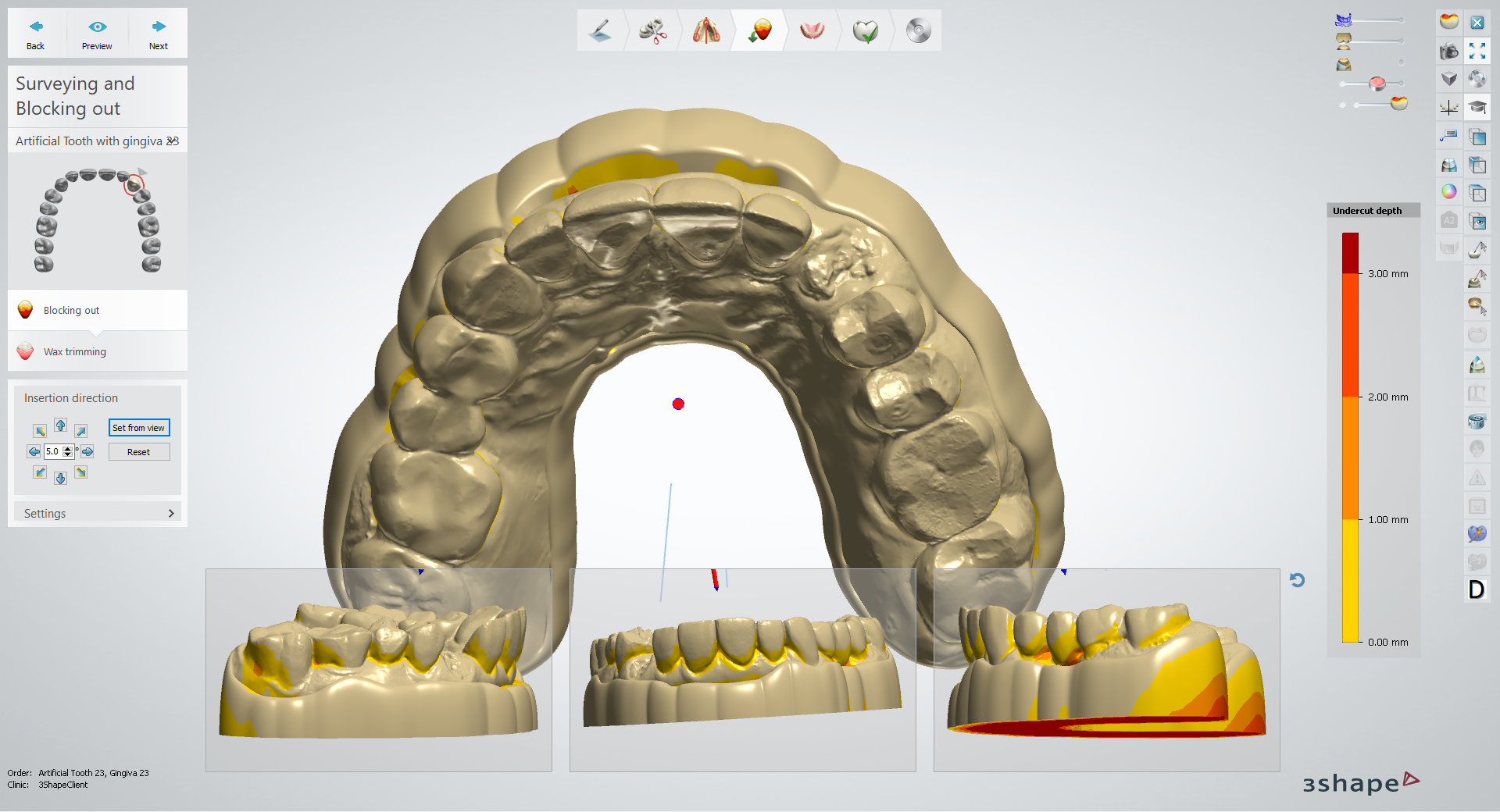 Workflow Guide: 3D Printing Flexible Dentures with HeyGears UltraCraft ...