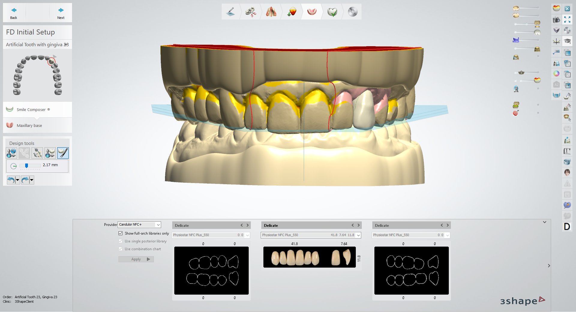 Workflow Guide: 3D Printing Flexible Dentures with HeyGears UltraCraft ...